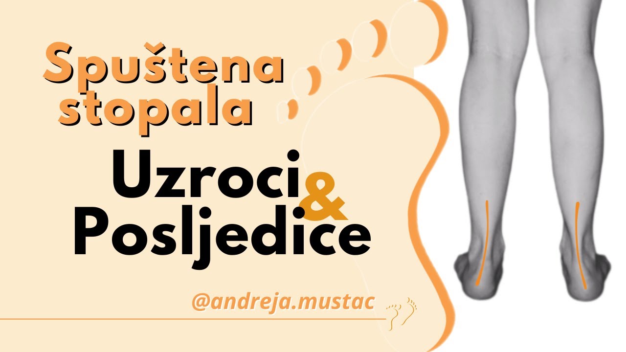Uzroci i posljedice spuštenih stopala na naše tijelo - YouTube