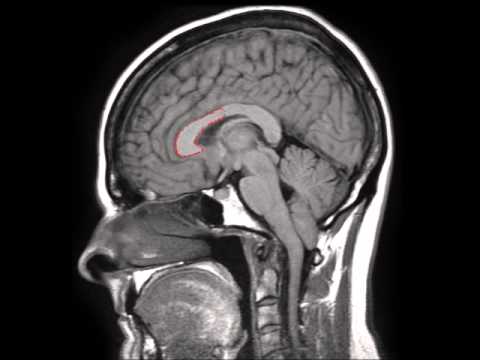 MRI corpus callosum - YouTube