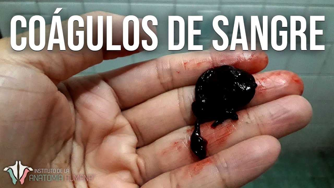 Lo que NECESITAS saber sobre los COÁGULOS DE SANGRE - YouTube