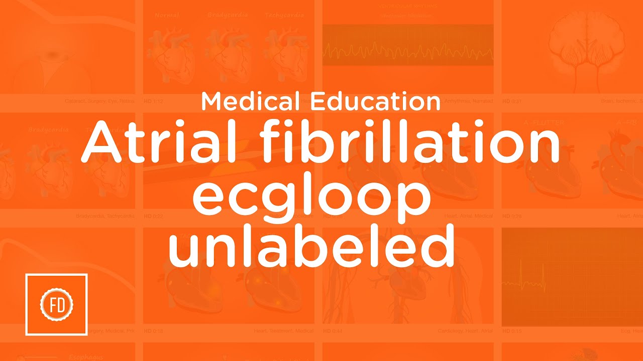 Atrial fibrillation ecg loop unlabeled | Medical Education | HD Video ...