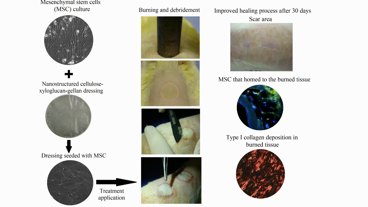 Nanostructured MSC hydrocolloid dressing for burn treatment - Video ...