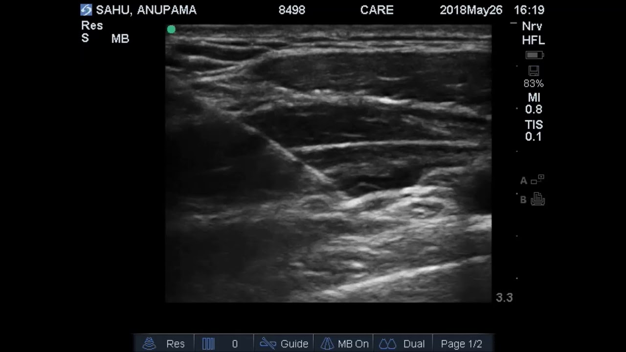 Ultrasound guided Costoclavicular Brachial Plexus Block - YouTube