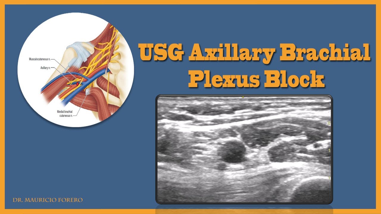 USG Axillary Brachial Plexus Block - YouTube