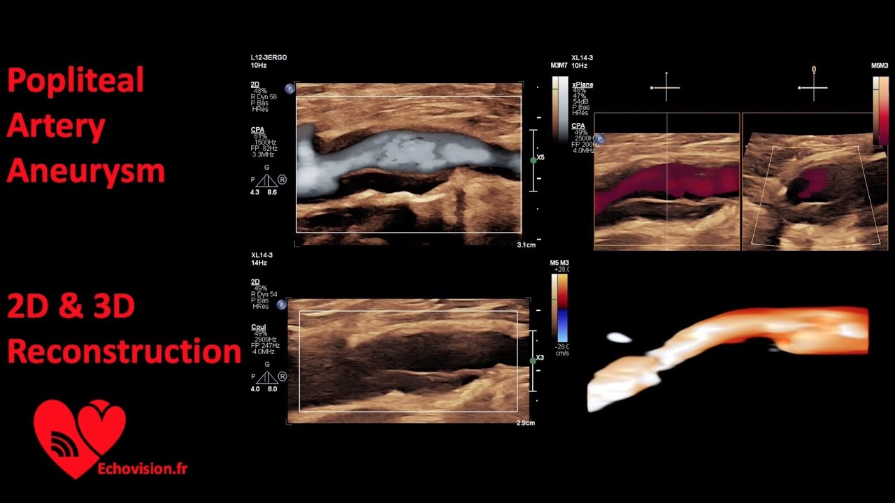 Popliteal Artery Aneurysm : 2D & 3D Reconstruction - YouTube
