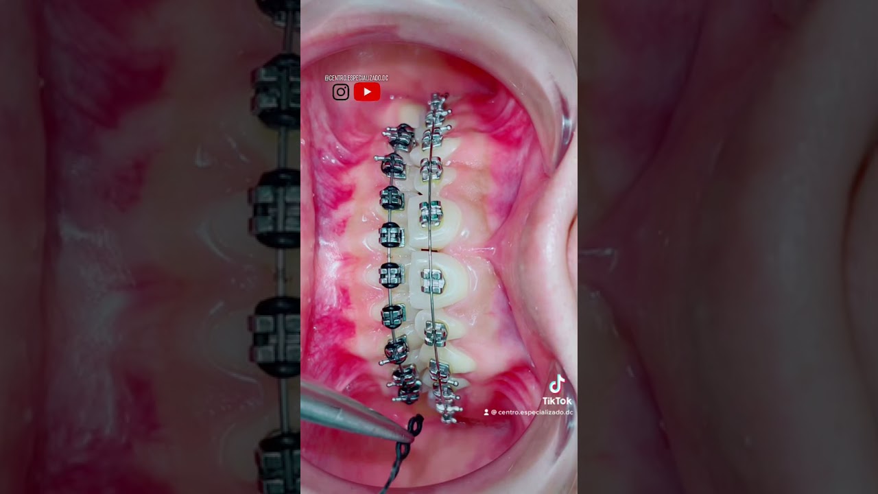 ¡Cadenas de color negro en los frenillos de metal! - YouTube