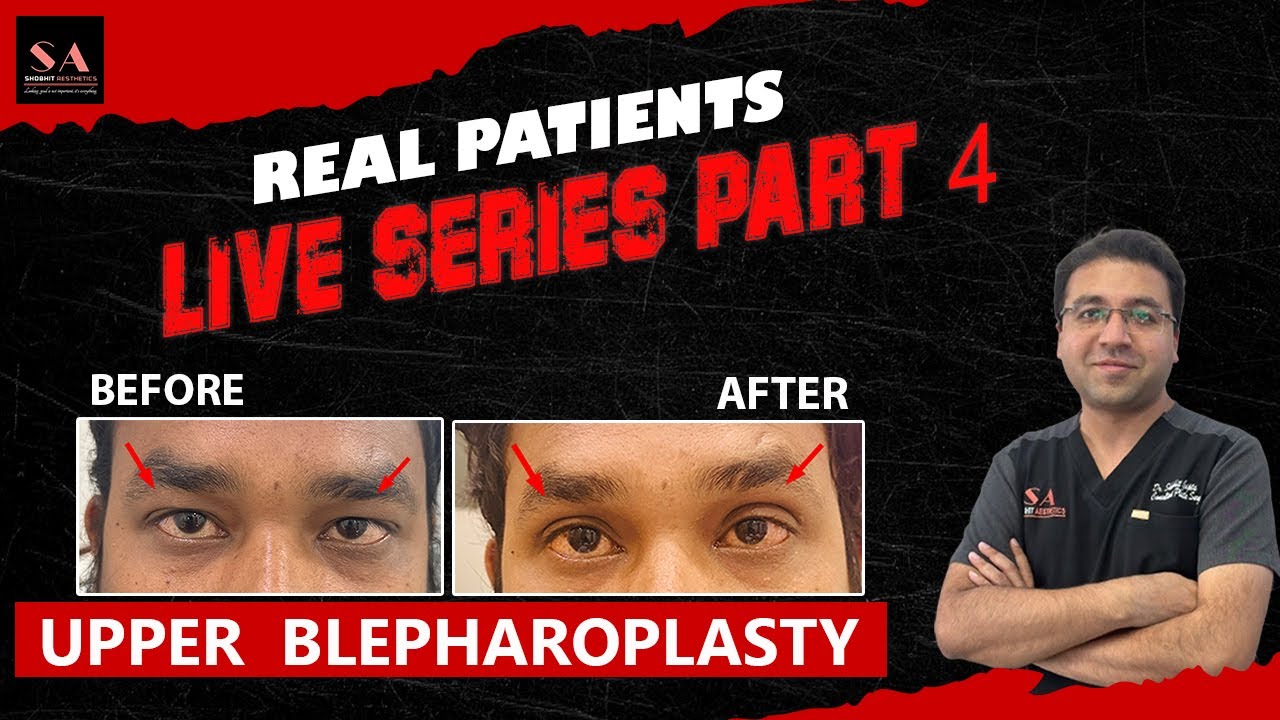 Live Result Series Part 4 Upper Blepharoplasty Results - Blepharoplasty ...