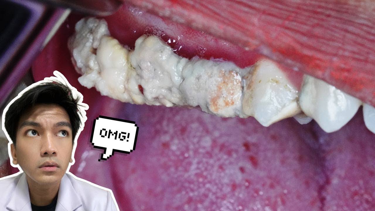 Deep Cleaning With HEAVY Tartar Build Up At The Dentist - YouTube