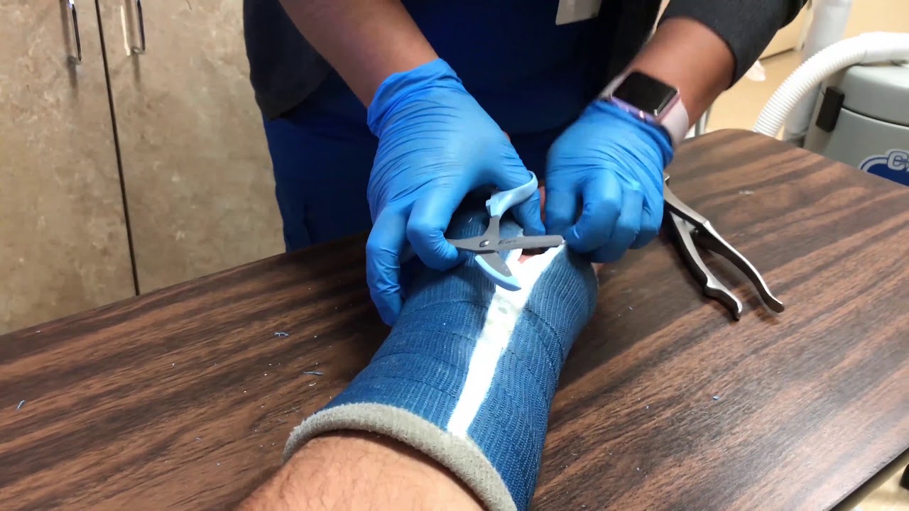 Getting cast On and Off with a buzz saw - YouTube