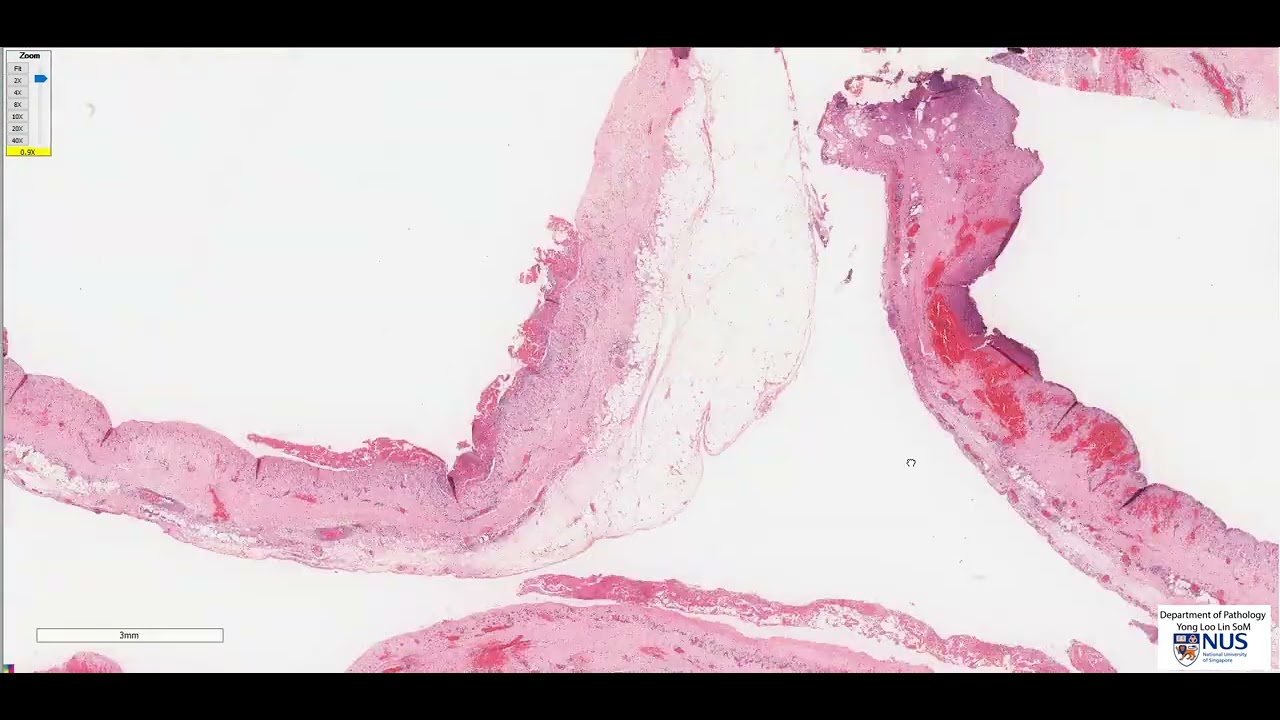 Heart Fibrinous Pericarditis Microscopy Talking Slide Youtube