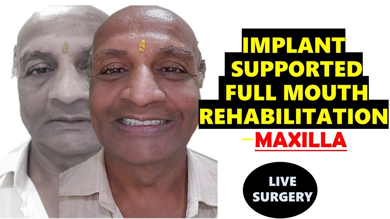 Implant Supported Full Mouth Rehabilitation -Maxilla( Step By Step Live ...