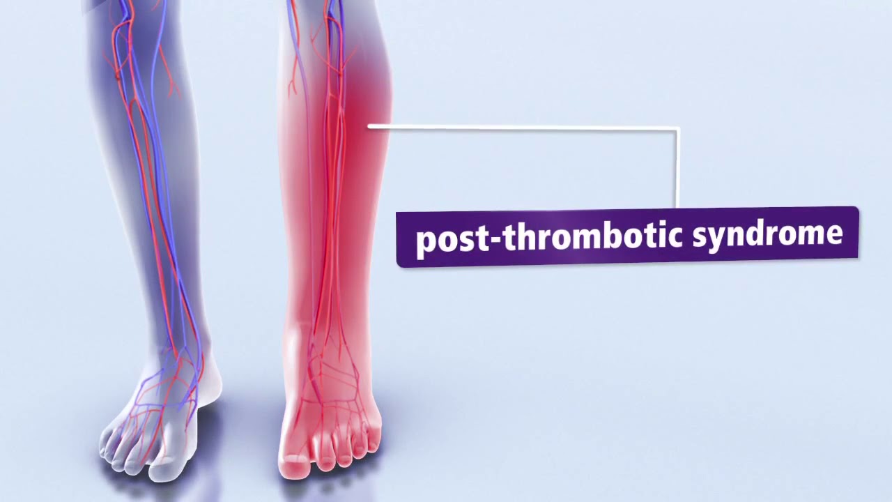 post thrombotic syndrome can be a consequence of DVT - YouTube