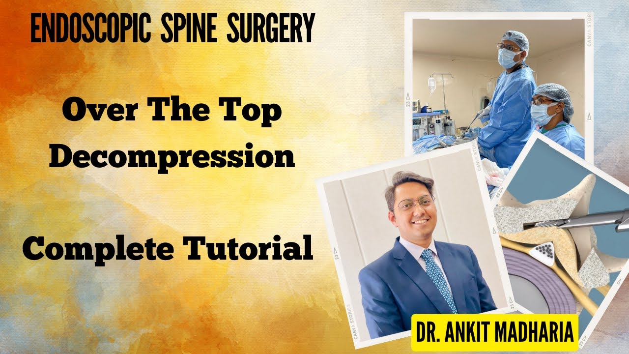Interlaminar Endoscopic Over the Top Decompression | Complete ...
