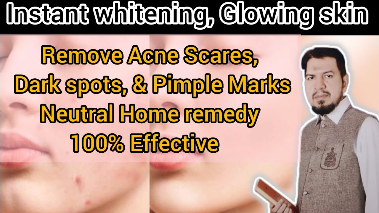 How to get Instant whitening skin At Home | Remove Acne Scars | Hakeem ...
