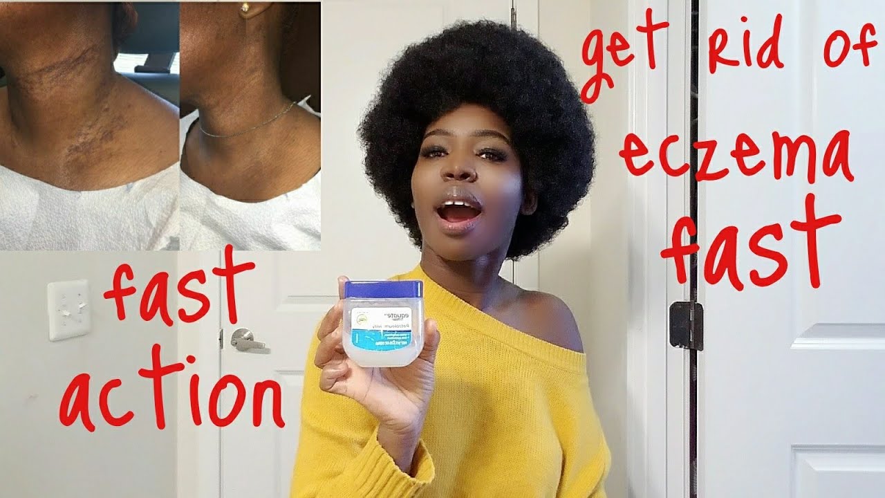 use vaseline to get rid of eczema fast - YouTube