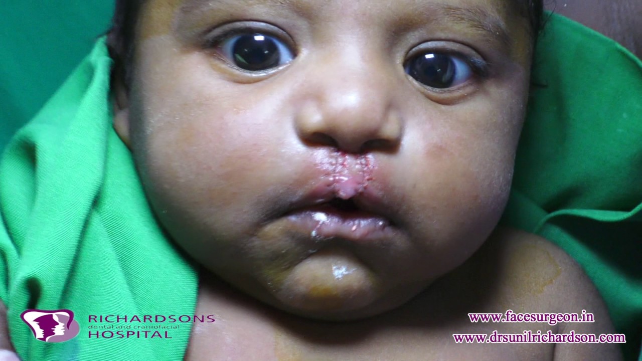 Bilateral incomplete before and one month later - YouTube