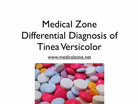 Medical Zone - Differential Diagnosis of Tinea Versicolor - YouTube