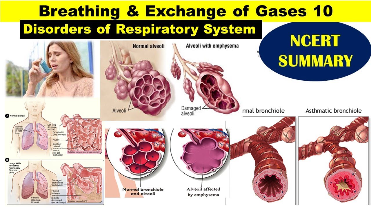 Breathing 10 | Respiratory disorders | Asthma | Emphysema ...