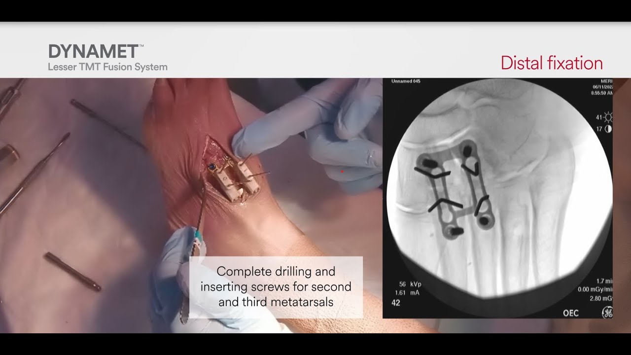 dynaMet™ Lesser TMT Fusion System - Cadaveric Surgical Demo - YouTube