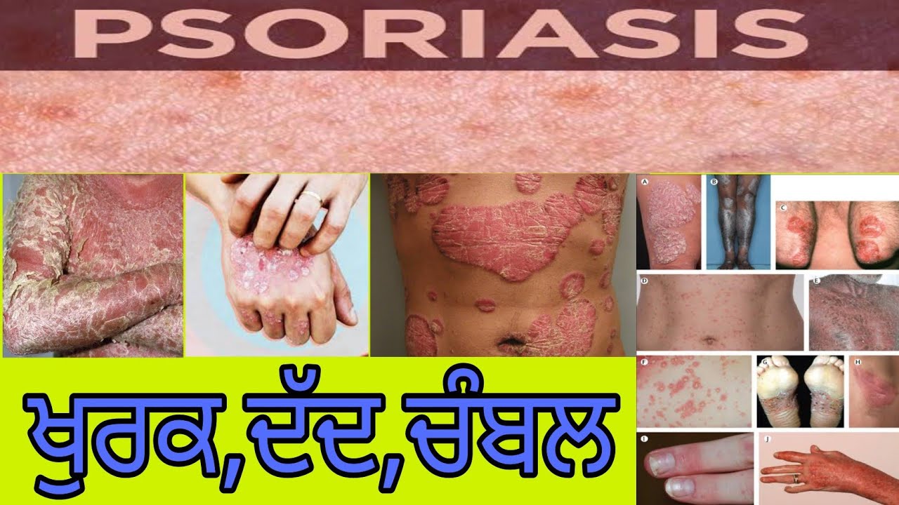 Psoriasis Daad Chambal Skin Problem ਖੁਰਕ ਦੱਦ ਚੰਬਲ ਚਮੜੀ ਰੋਗ खाज दाद ...