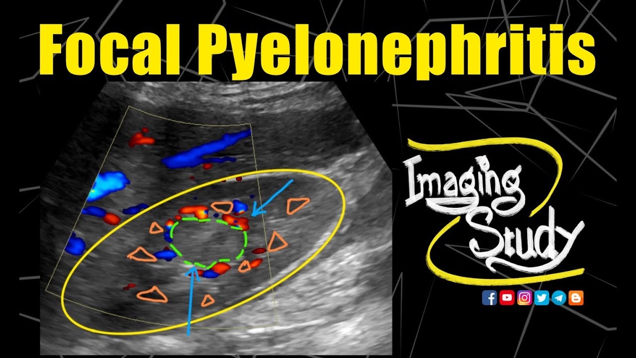 Focal Pyelonephritis in Pregnancy || Ultrasound || CT || Case 192 - YouTube