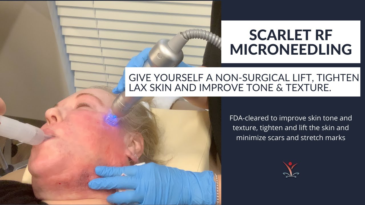Improve Your Skin with Scarlet SRF - YouTube