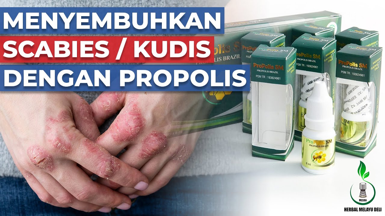 Gejala Scabies & Kudis yang Perlu Diwaspadai dan Cara Mengatasinya ...