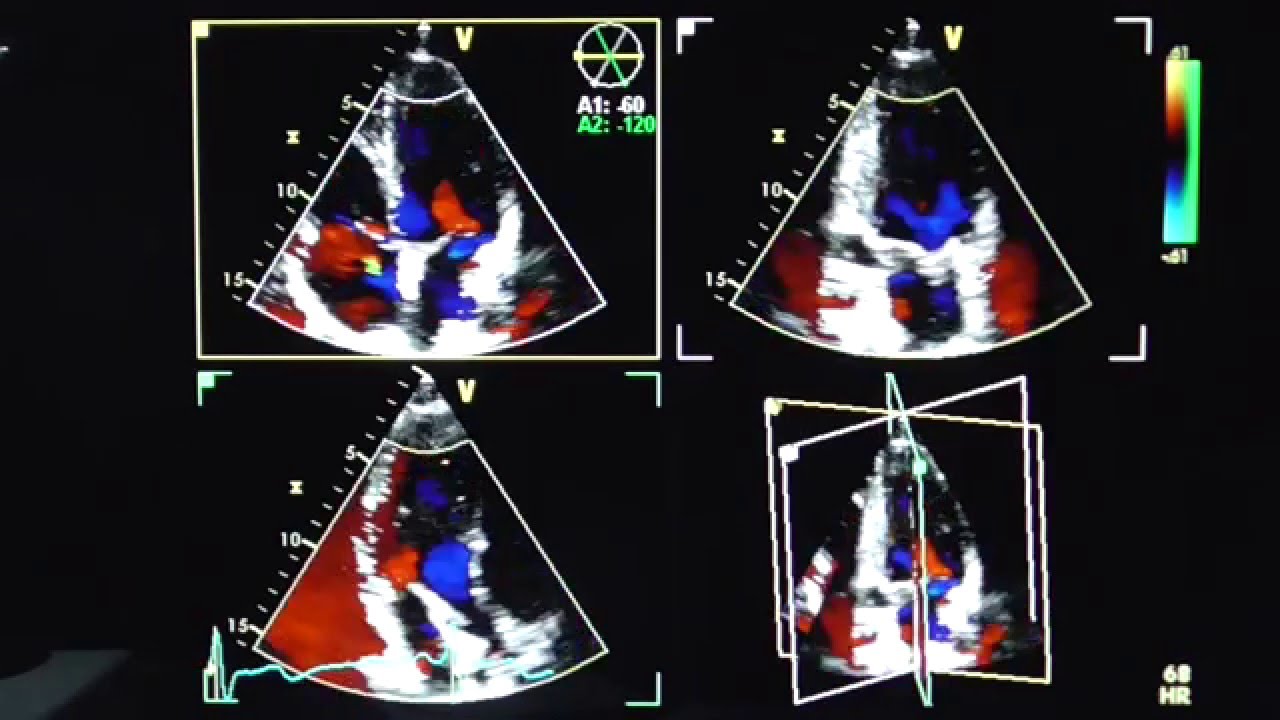 3D farbkodierte Doppler-Darstellung ( 3D with doppler imaging) - YouTube