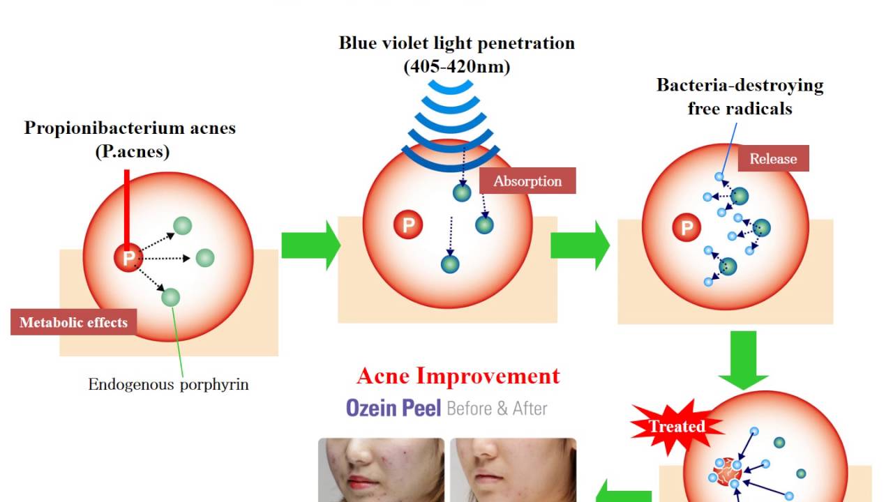 ozone therapy , ozein peeling - YouTube