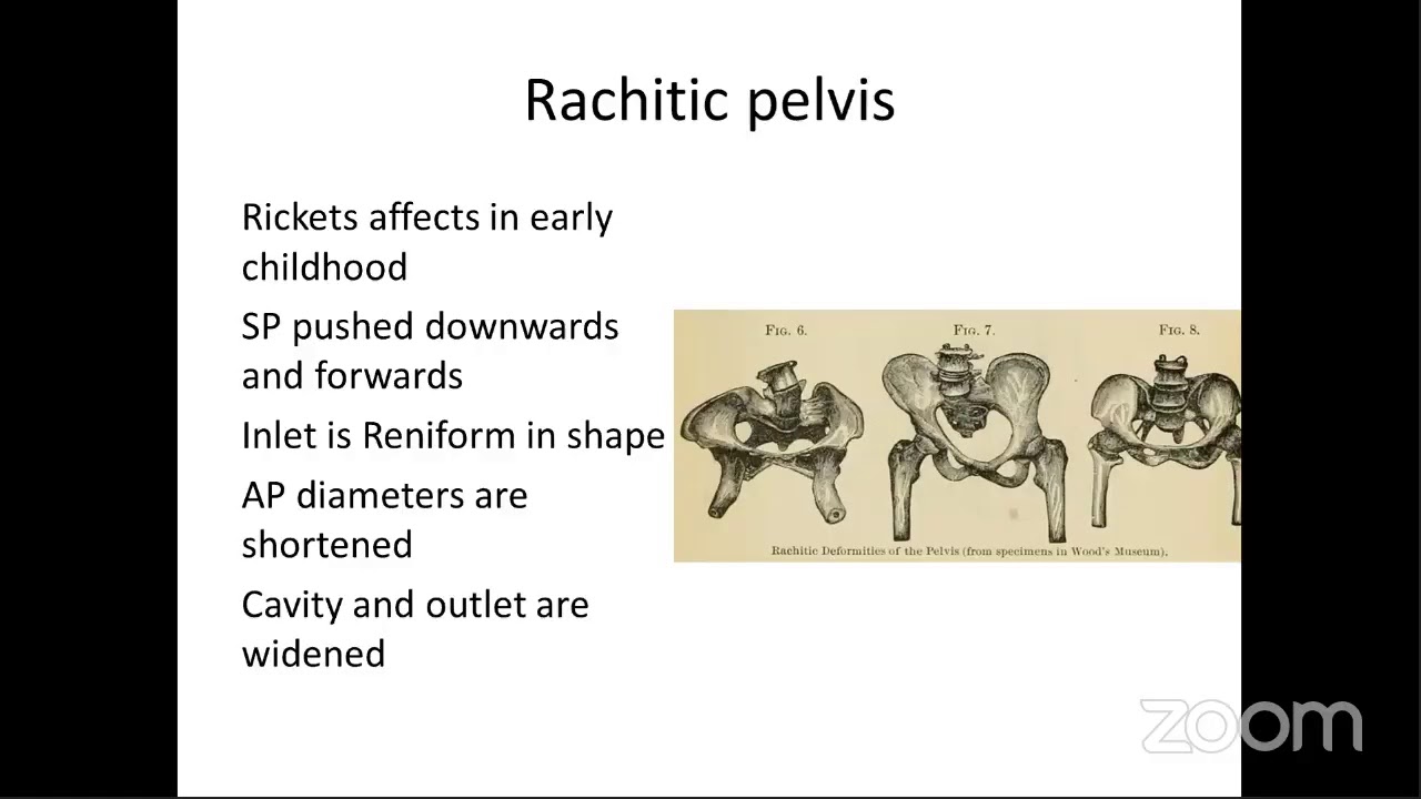 Rachitic Pelvis