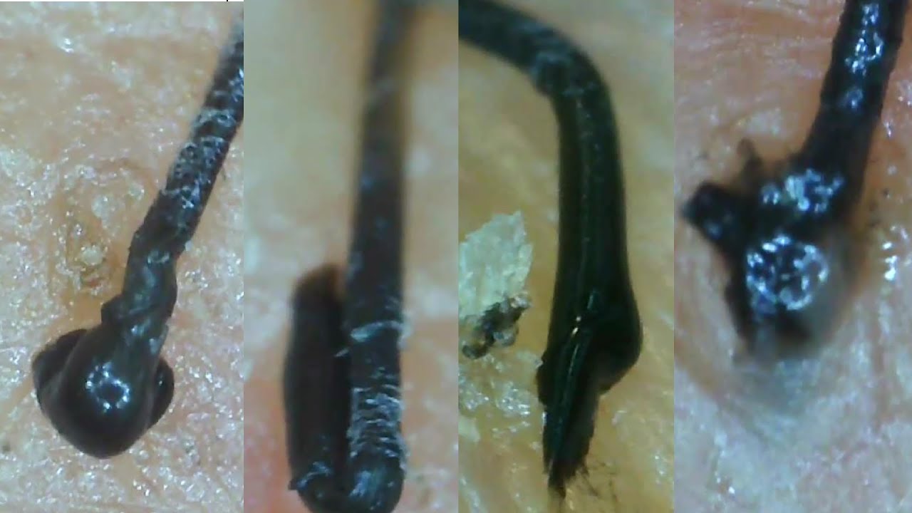 #021 Pull Out Beard Blackhead Hair Root 毛抜き 毛根 拡大 ひげ - YouTube