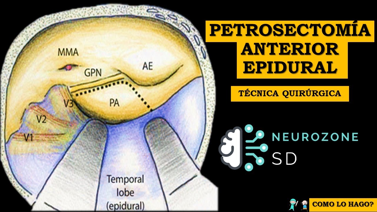 Petrosectomía anterior - YouTube