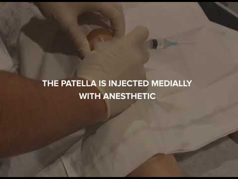 Knee Arthrogram For Minuscule Tear For Motor Vehicle Accident Victim ...