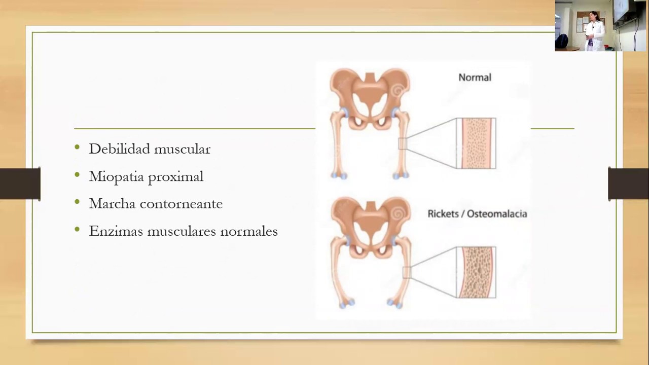 Raquitismo y Osteomalacia - YouTube