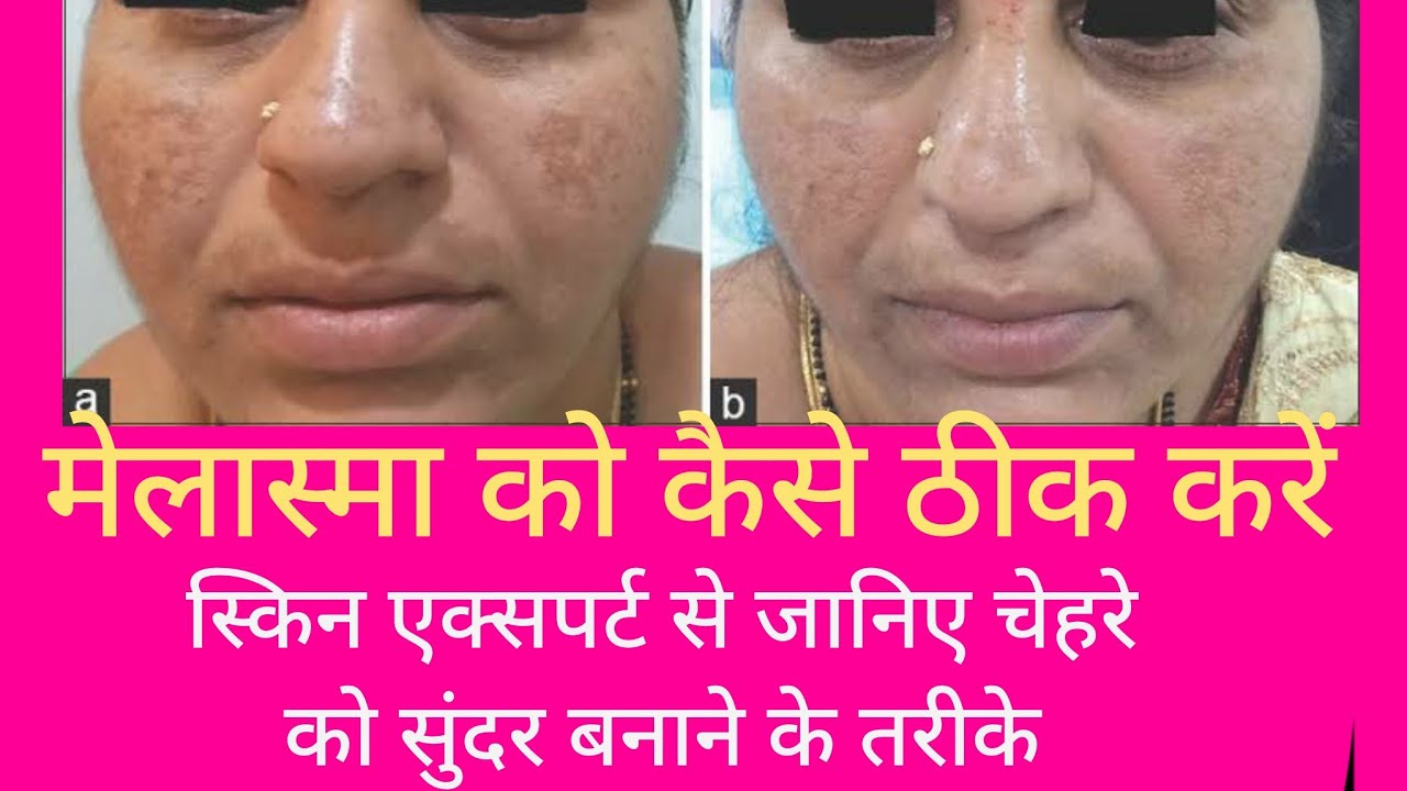 How to get rid of Melasma|| झाईं को कैसे ठीक करें - YouTube