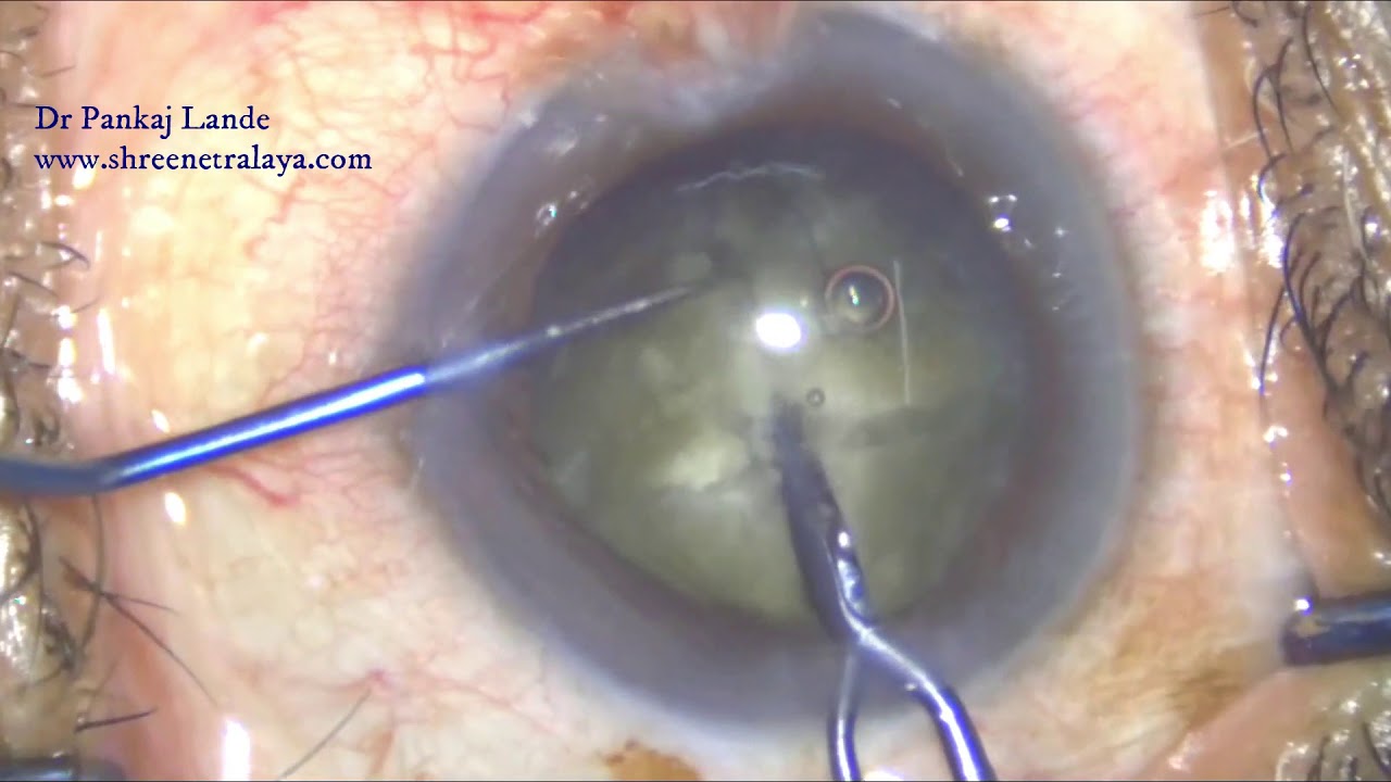 pre chopper hard cataract DR PL - YouTube