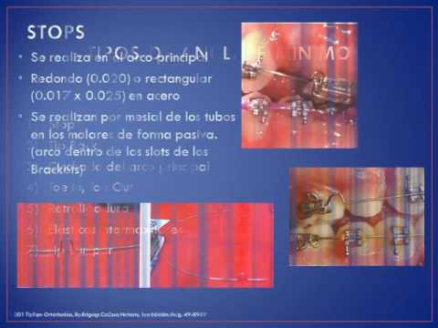 El Anclaje en Ortodoncia - YouTube
