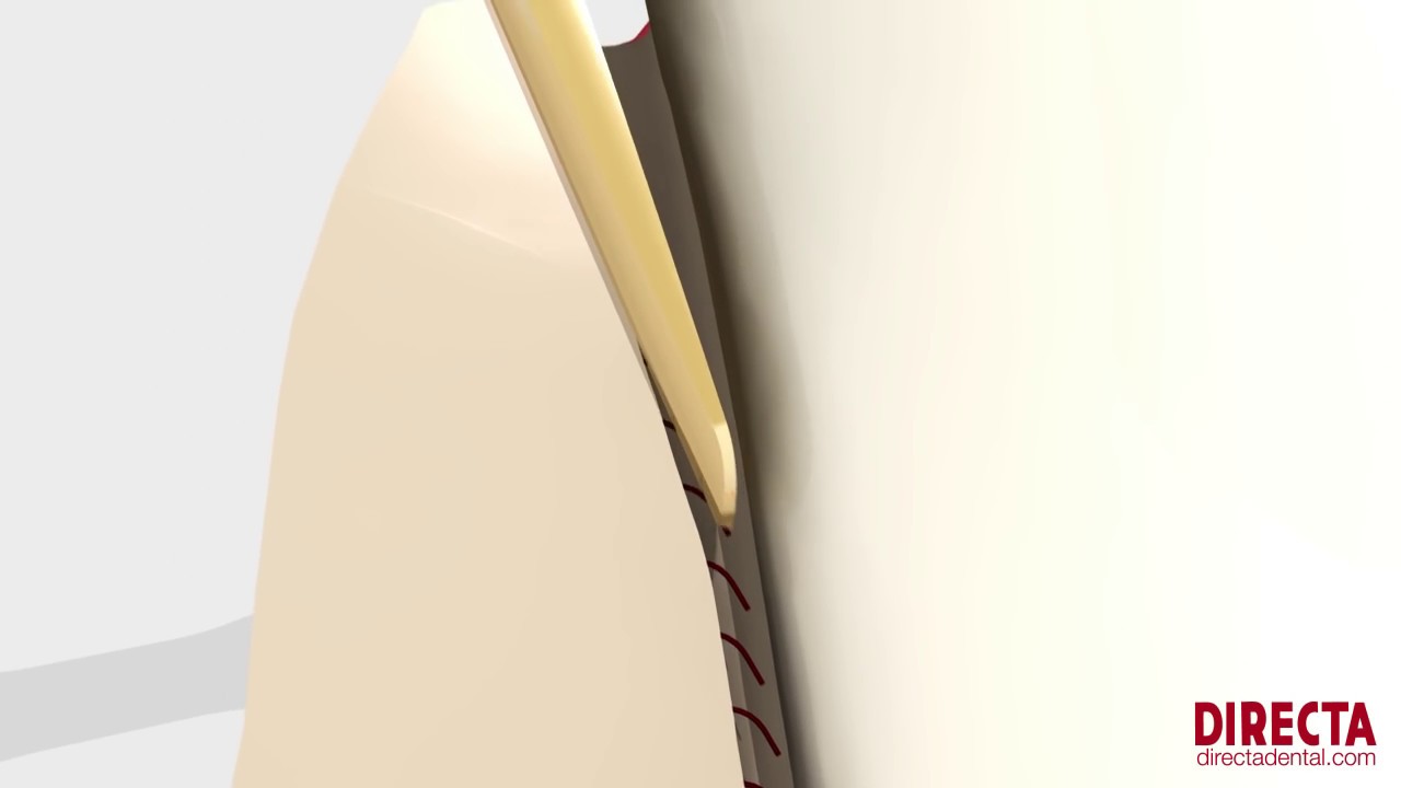 Luxator® LX by Directa - Mechanical Periotome by Directa - YouTube