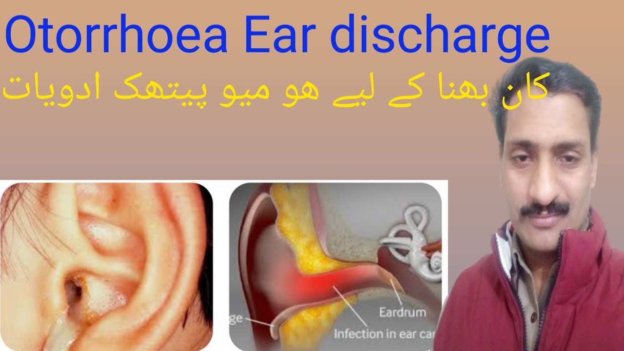 Otorrhoea it's causes symptoms and homeopathic medicine - YouTube