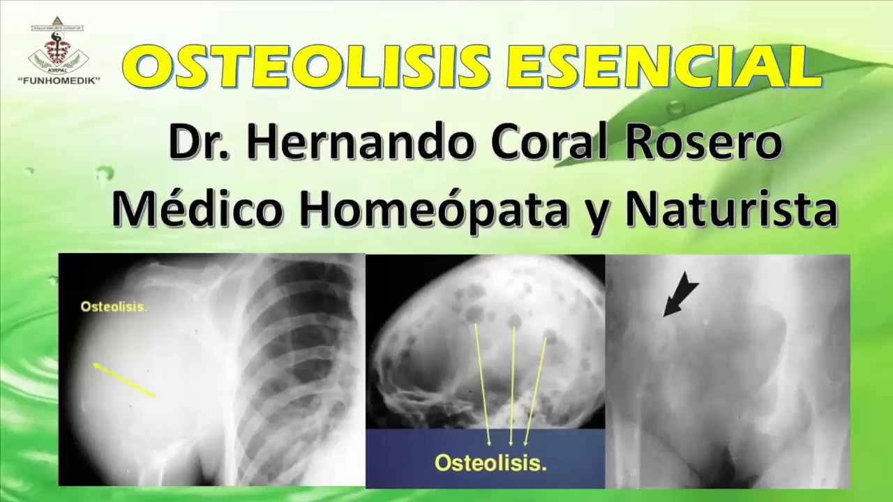 OSTEOLISIS ESENCIAL (DESTRUCCIÓN Y RESORCIÓN ÓSEA) - YouTube