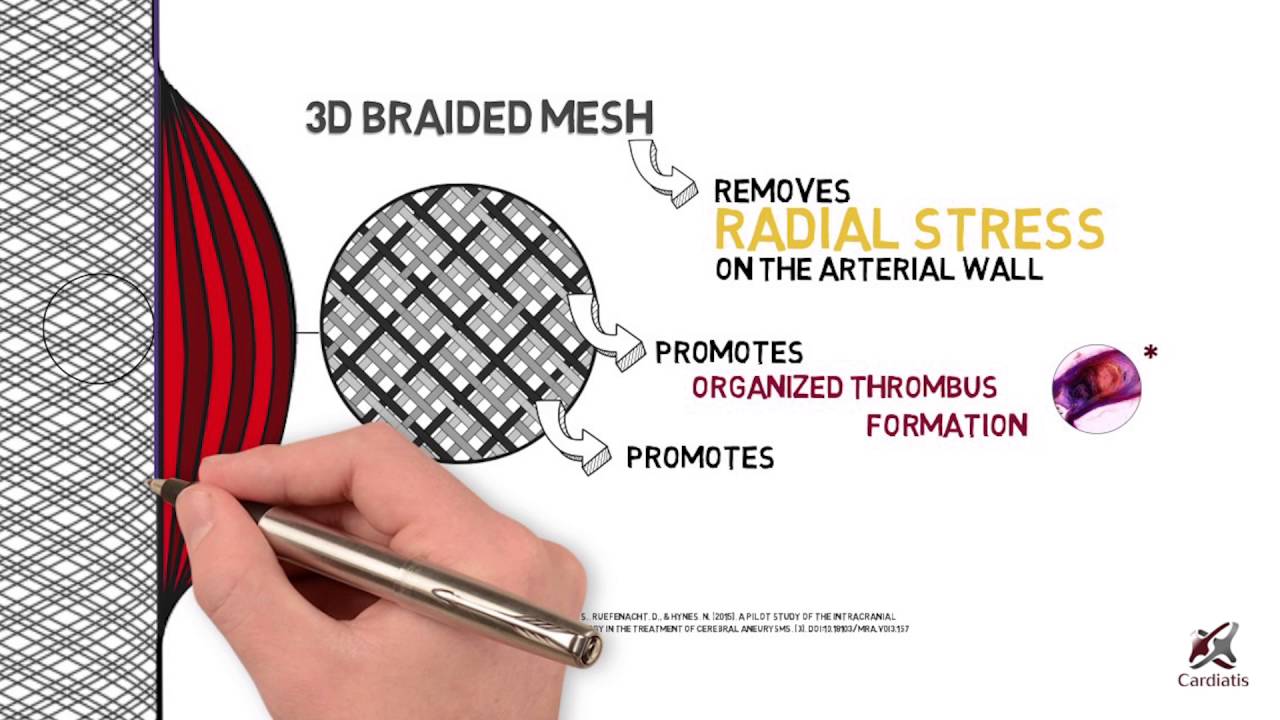 MFM by Cardiatis - YouTube