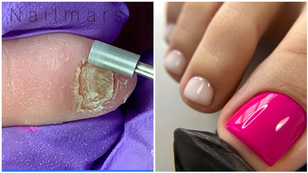 Most Satisfying Pedicure Transformation 😱 best nail polish for toes ...