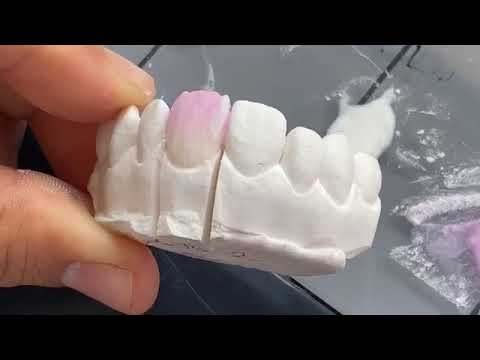 Demostración de la estratificación de una carilla feldespática en modelo refractario completo Parte2