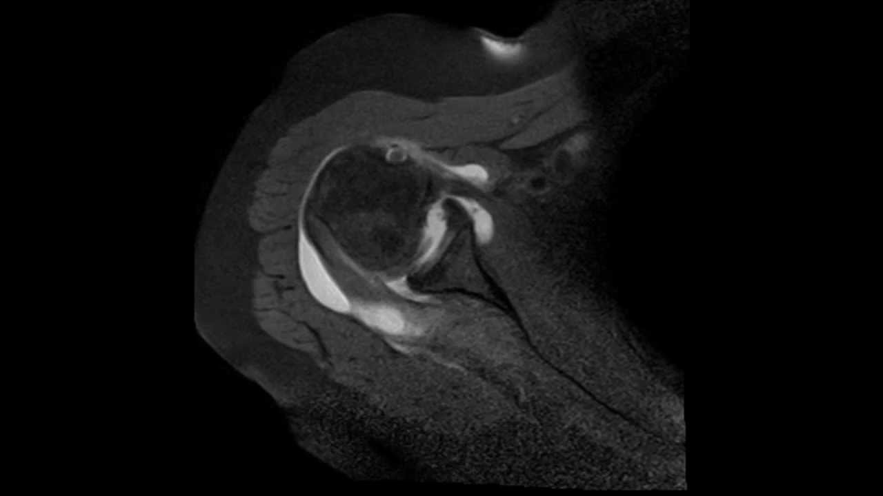 Rupture of the SSP-tendon and ISP-tendon of the shoulder - complete MRI ...