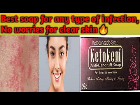 Ketokem soap uses and side effects in telugu.Best soap for fungal ...