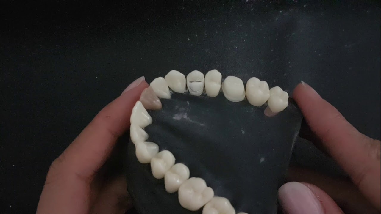 PASSO A PASSO DE PREPARO ONLAY - YouTube