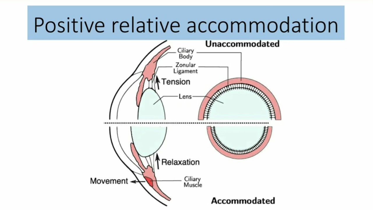 Orthopics series 3 : Positive relative accommodation (PRA) - YouTube