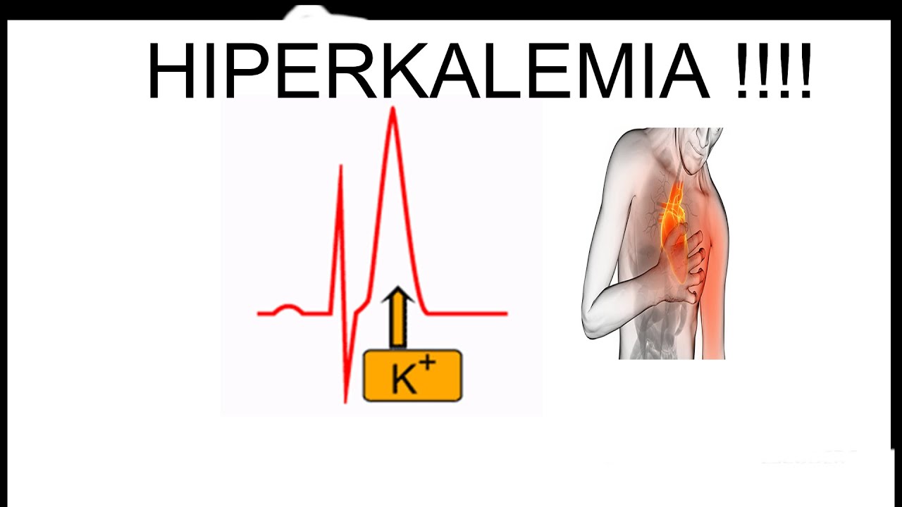 HIPERKALEMIA. ENFOQUE Y TRATAMIENTO - YouTube
