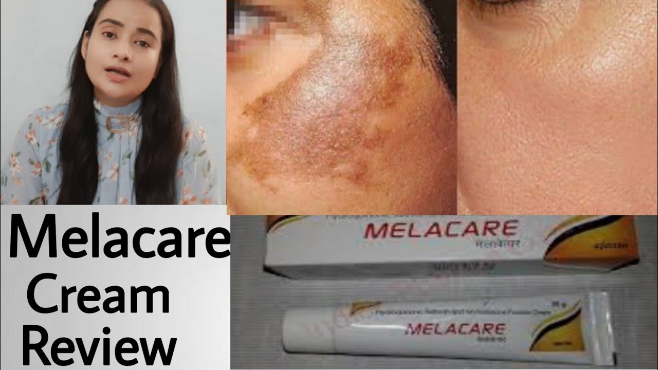 Melacare Cream Review |हिन्दी मैं | मेलाकेयर क्रीम उपयोग फायदे और ...