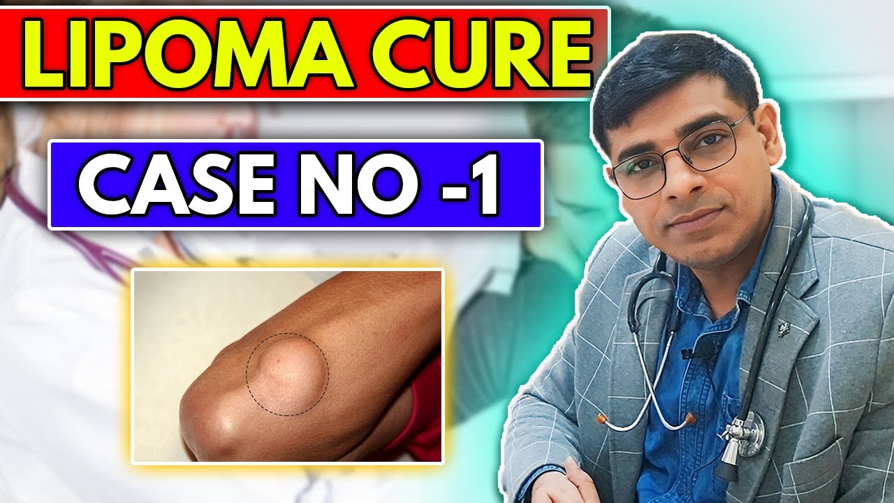 LIPOMA Cure Case No 1 | Cure Case of Lipoma | Lipoma Cured by ...