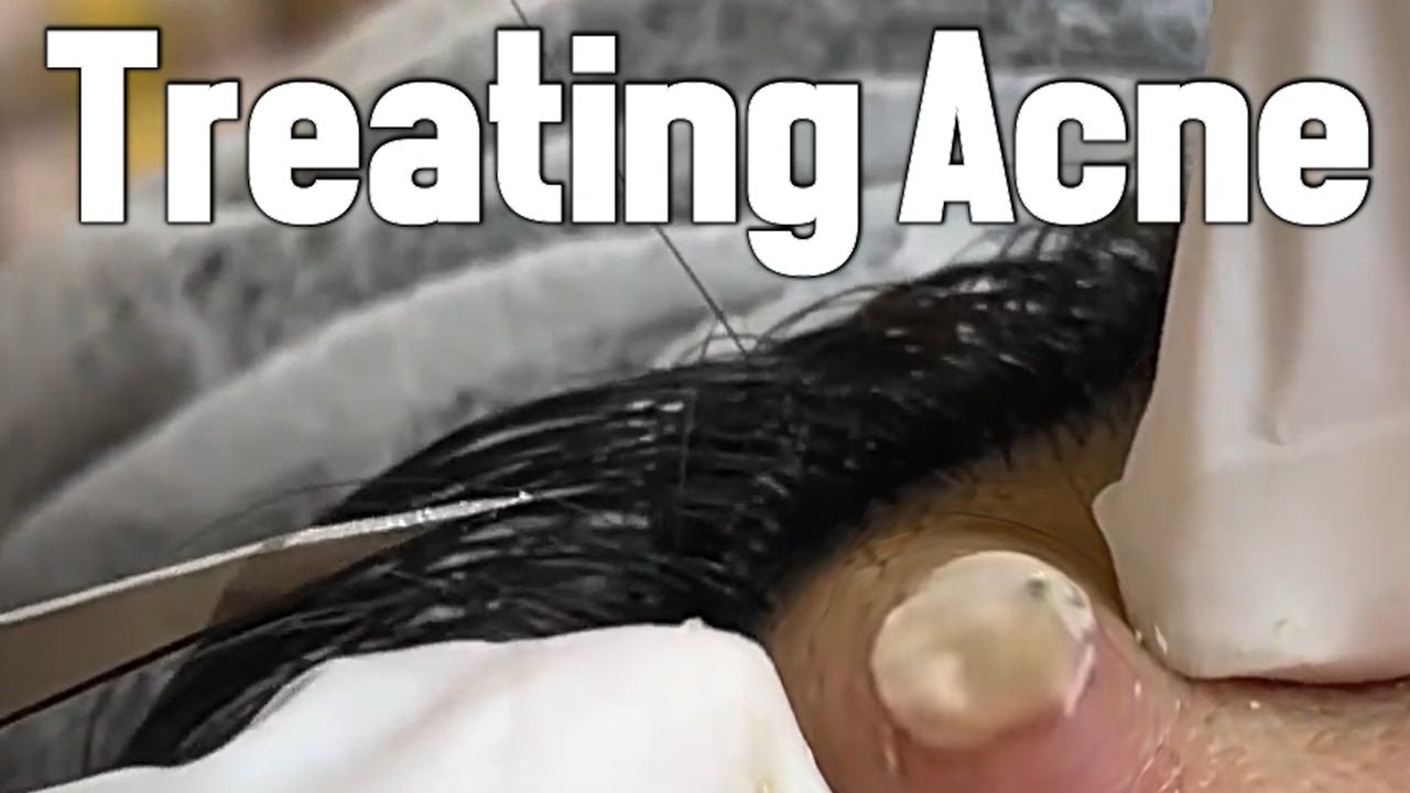 Acne Cysts! Cyst Removal, Pimple Popping and Dermatology! - YouTube